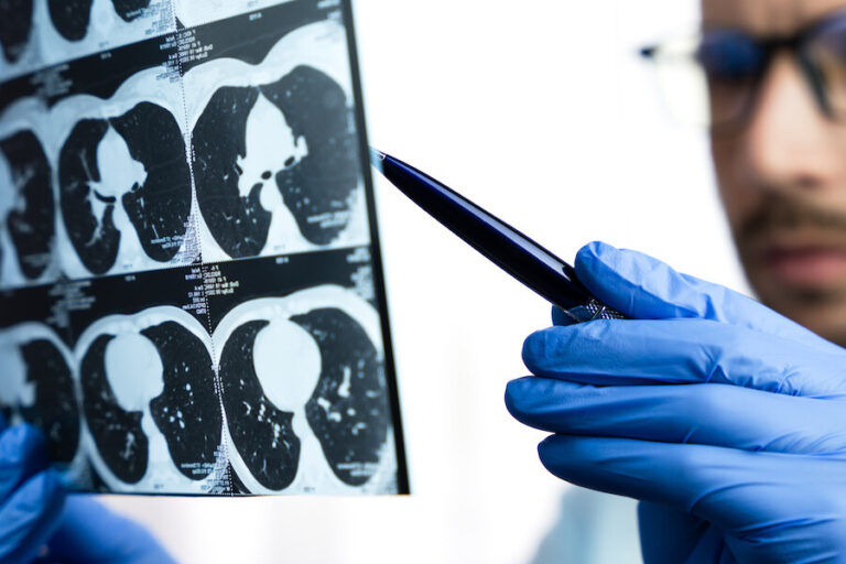Lung Cancer Screening Can Save Lives — Get Screened Today
